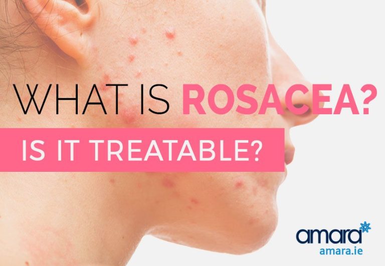 Rosacea | Amara Clinic